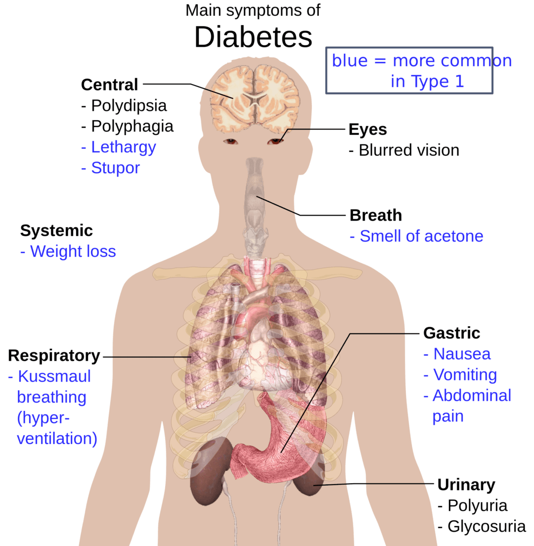 Diabetes Mellitus Everything You Need To Know